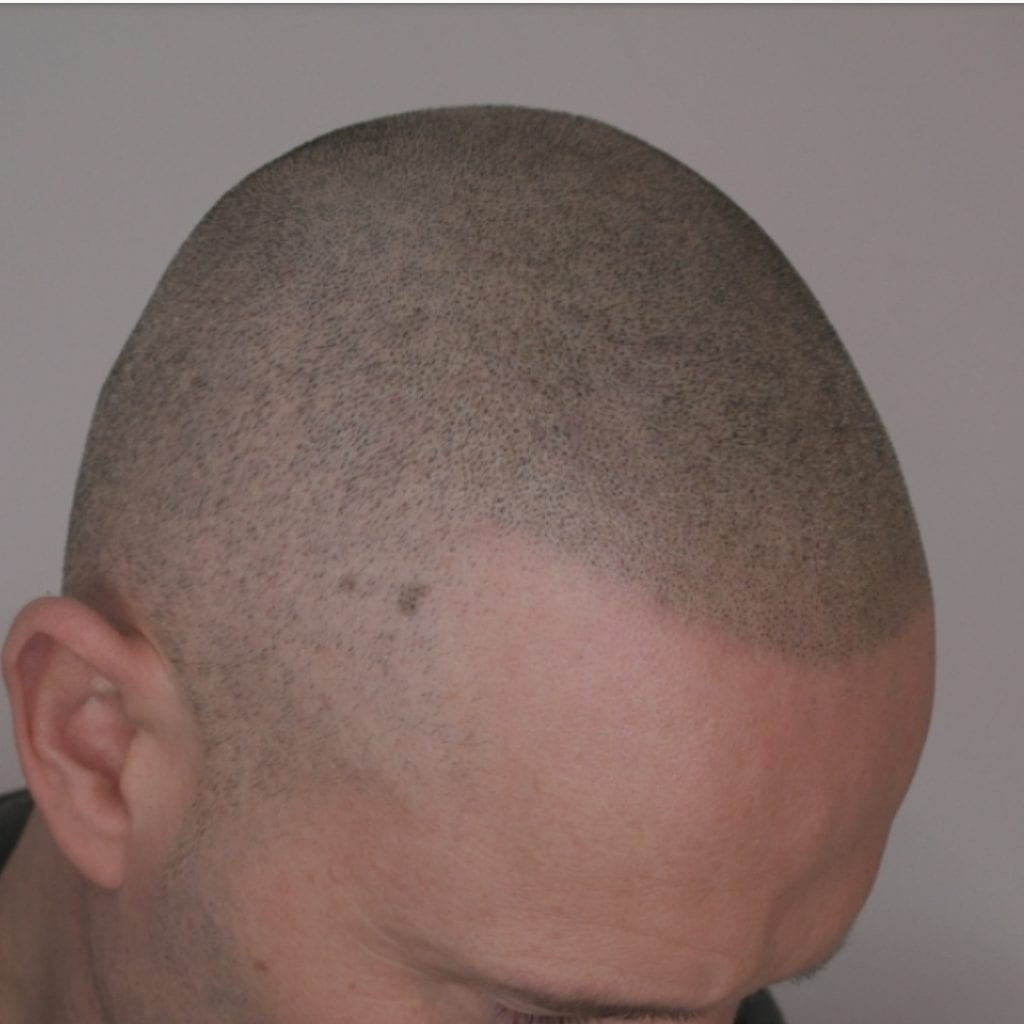 Виталий Бобер — Отзывы, Цены - специалист по трихопигментации кожи ...